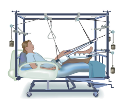 Extra weights are utilized to maintain alignment of the fractured bone ...