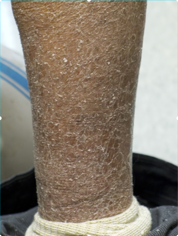 Extra chronic, inherited skin disorder characterized by diffuse dermal ...