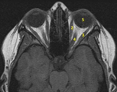 Back Extra 2= medial rectus, 3= lateral rectus, 4= optic nerve, 5 ...
