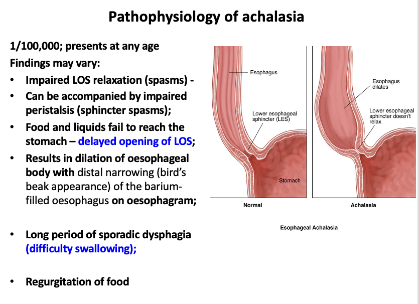 Front What is Achalasia?
