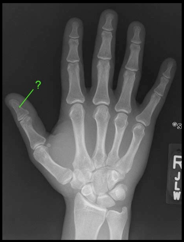 Text {{c1::Distal}} phalanx