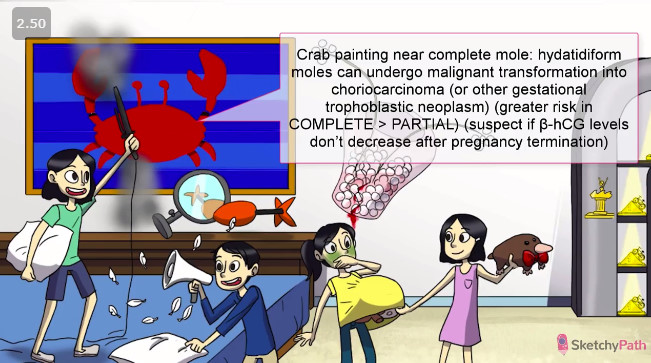 Extra Q13 Ploidy of partial mole