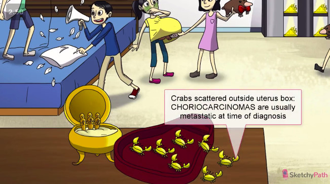 Extra Q17 Chorio-carcinoma occurs MOST commonly after which abnormal ...