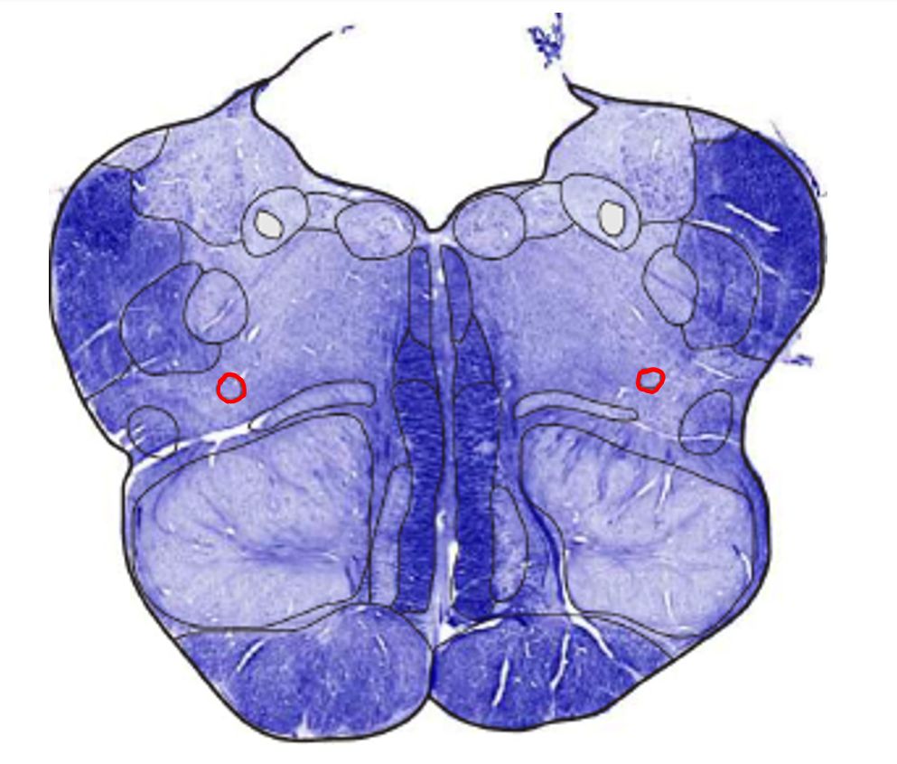 answer nucleus ambiguus(mid medulla)
