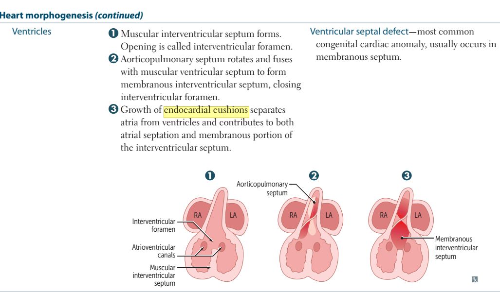 Interventricular Foramen Heart