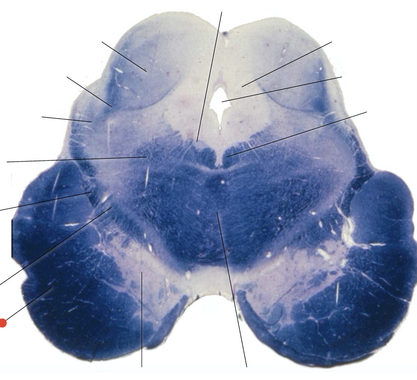 Text {{c1::Cerebral Peduncle}}