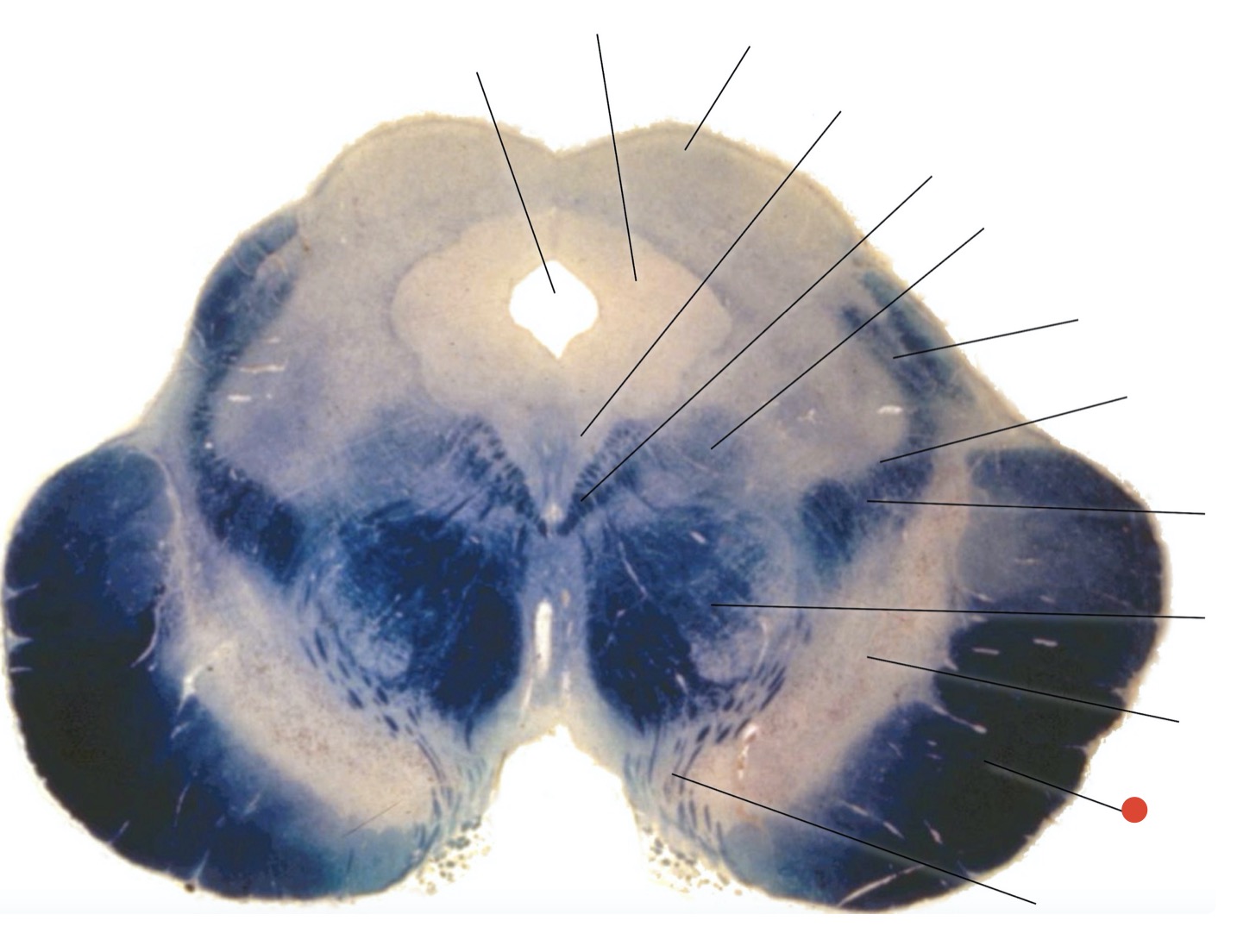 Text {{c1::Cerebral Peduncle}}