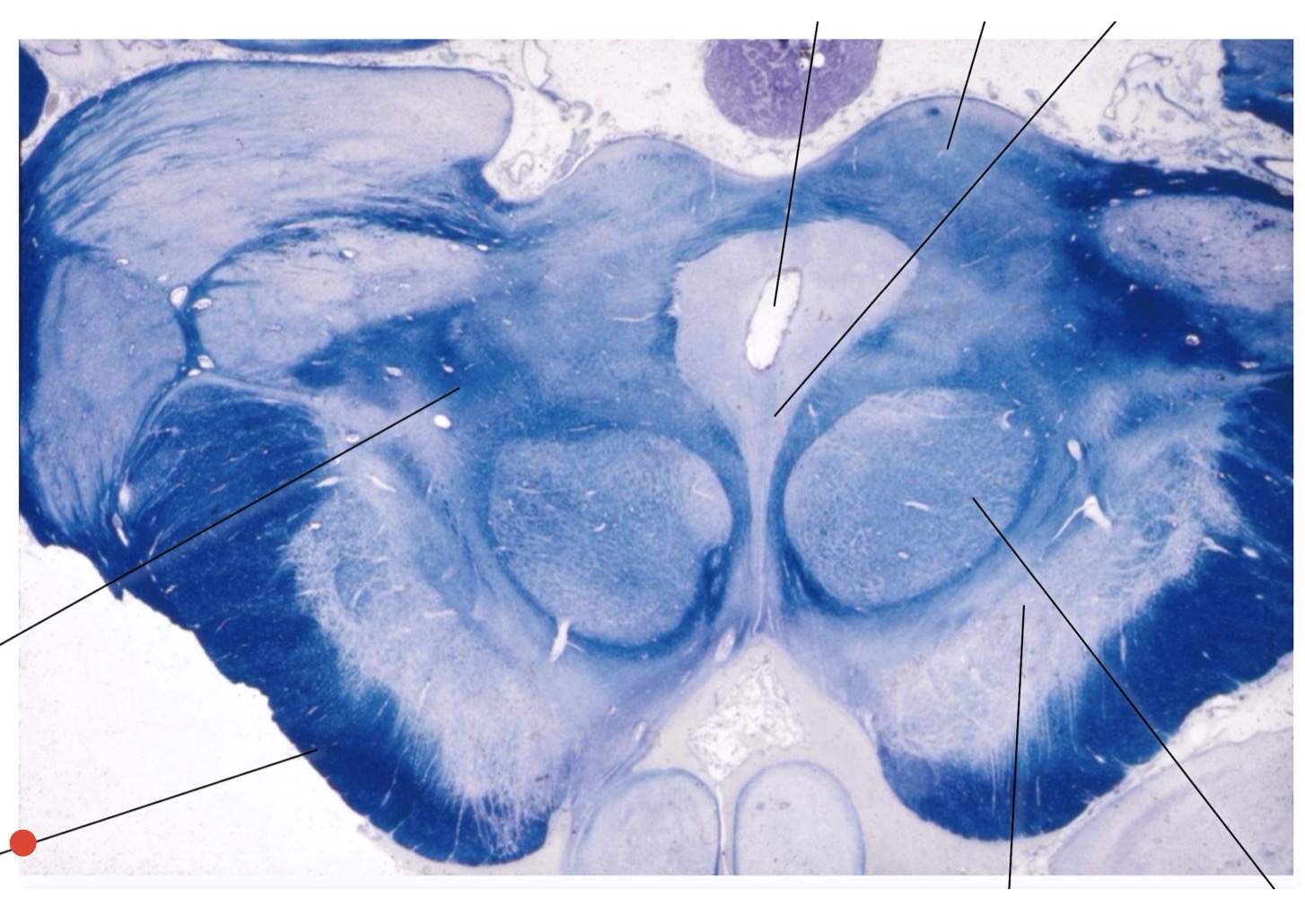 Text {{c1::Cerebral Peduncle}}