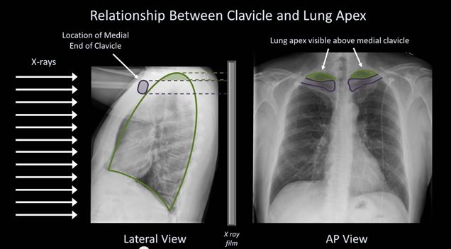 Back y axis rotation - lodortic view consequence of upward rotation of ...