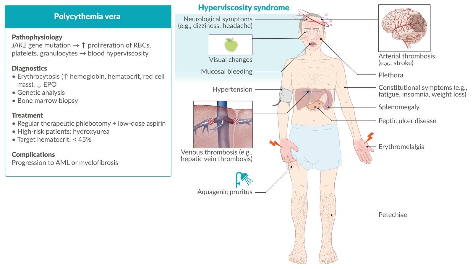 ↑ RBC leading to ↑ blood viscosity leading to ↓ normal blood flow and reduced O2 delivery ...