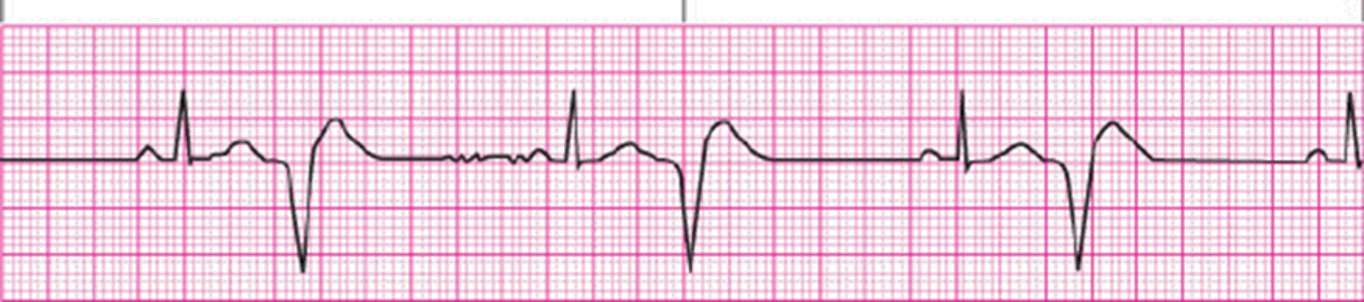 Front What condition of the ECG strip is shown below?