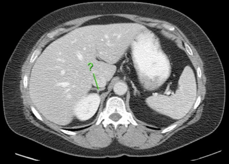 Text {{c1::Adrenal gland::Structure?}}
