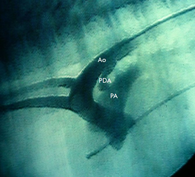 Back PDA:angiography