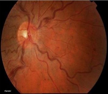 dilated and tortuosis veins in all 4 quadrans with minimal haemorrhages ...