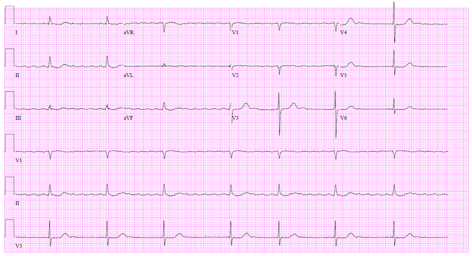 Back -Bradycardic OR tachycardic -Irregular rhythm-No P to QRS, BUT P ...