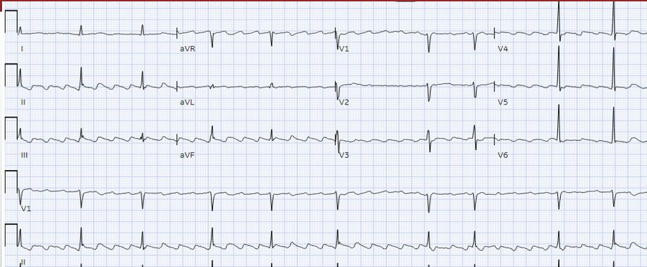 Text This EKG shows a very classic "sawtooth" pattern that is ...