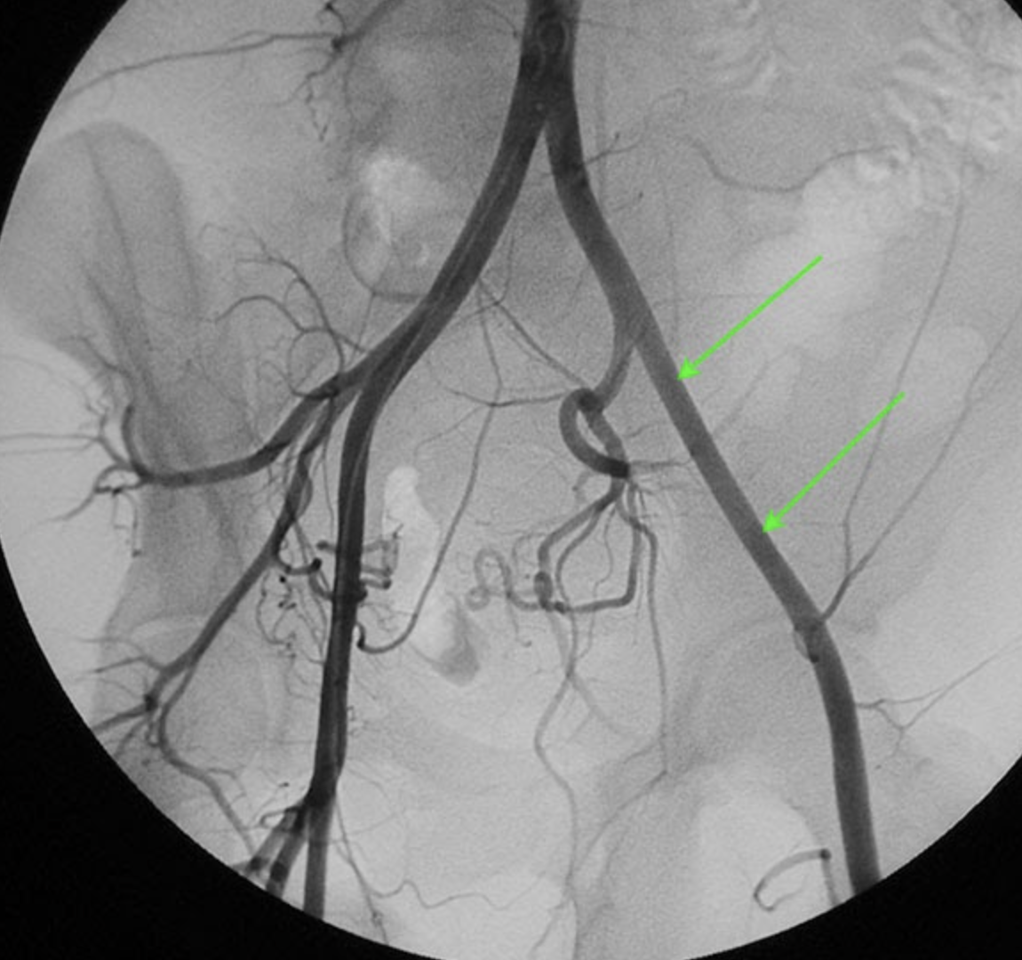 Text {{c1::Left exterior iliac artery::Artery?}}