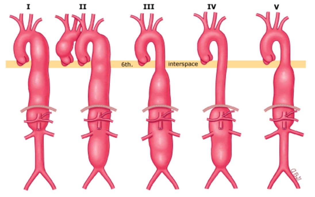 Front Crawford classification for abdominal thoracoabdominal aneurysms?