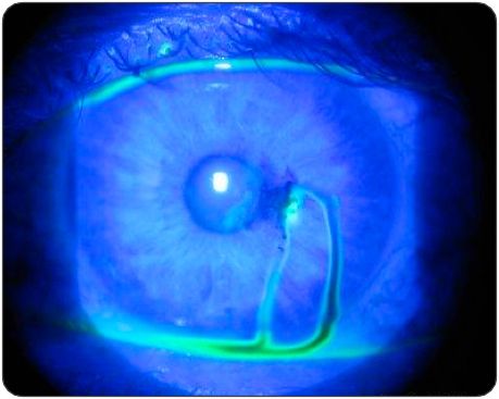 pt w/ R eye pain & tearing & ↓visual acuity. dx? {{c2::Globe Rupture ...
