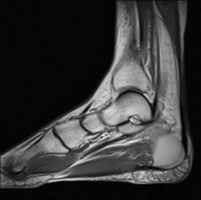 Front A 28-year-old man with foot pain after running