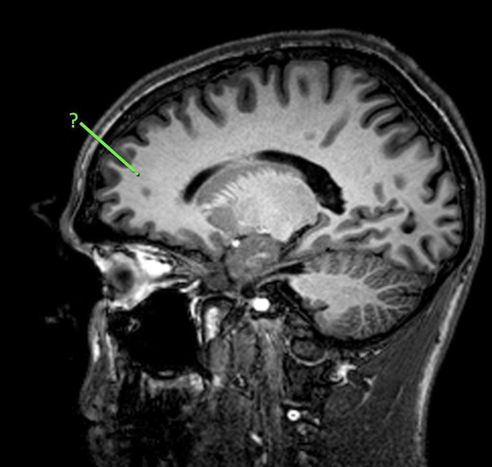 Text {{c1::Frontal}} lobe