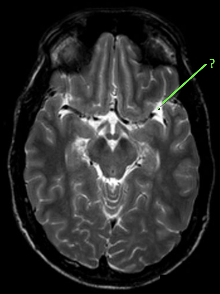 Text {{c1::Lateral fissure::Structure?}}
