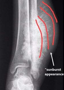Osteosarcoma Sunburst Appearance Intramedullary Osteosarcoma Of The