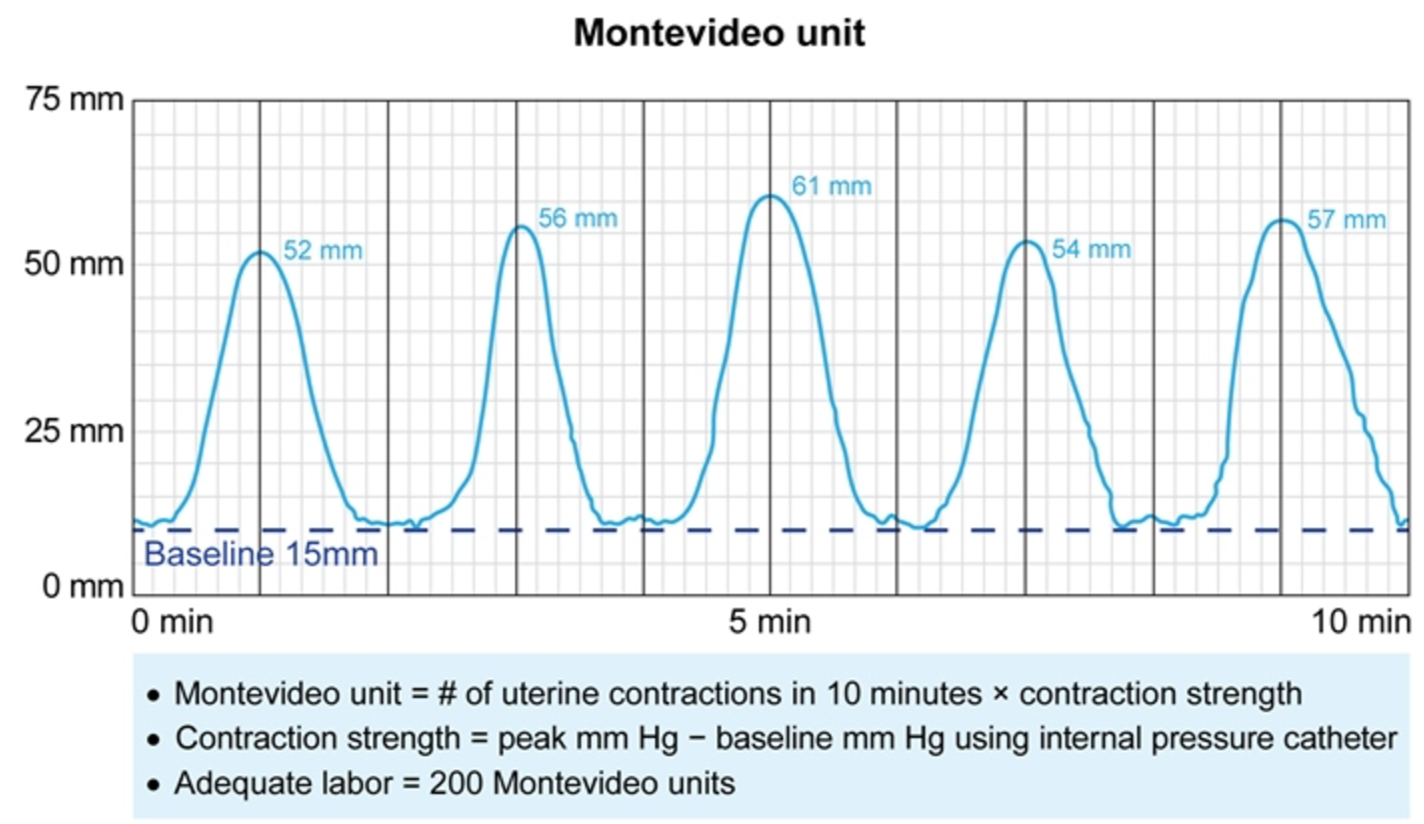 MVU = # uterine contractions in 10 minutes x contraction ...