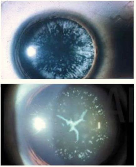 identify type of cataract