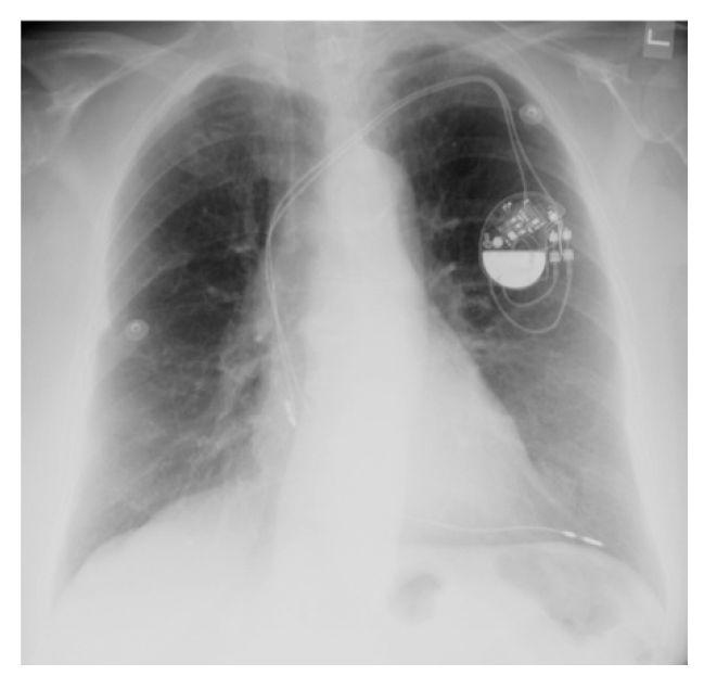 Front What is the location of the atrial and ventricular pacemaker lead ...