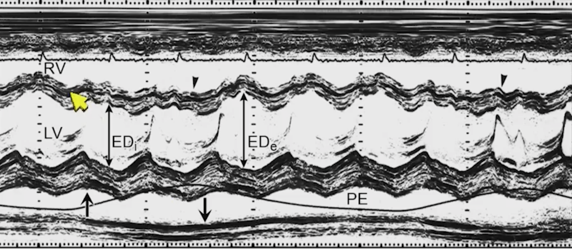 Text What does this M-Mode Tracing show?