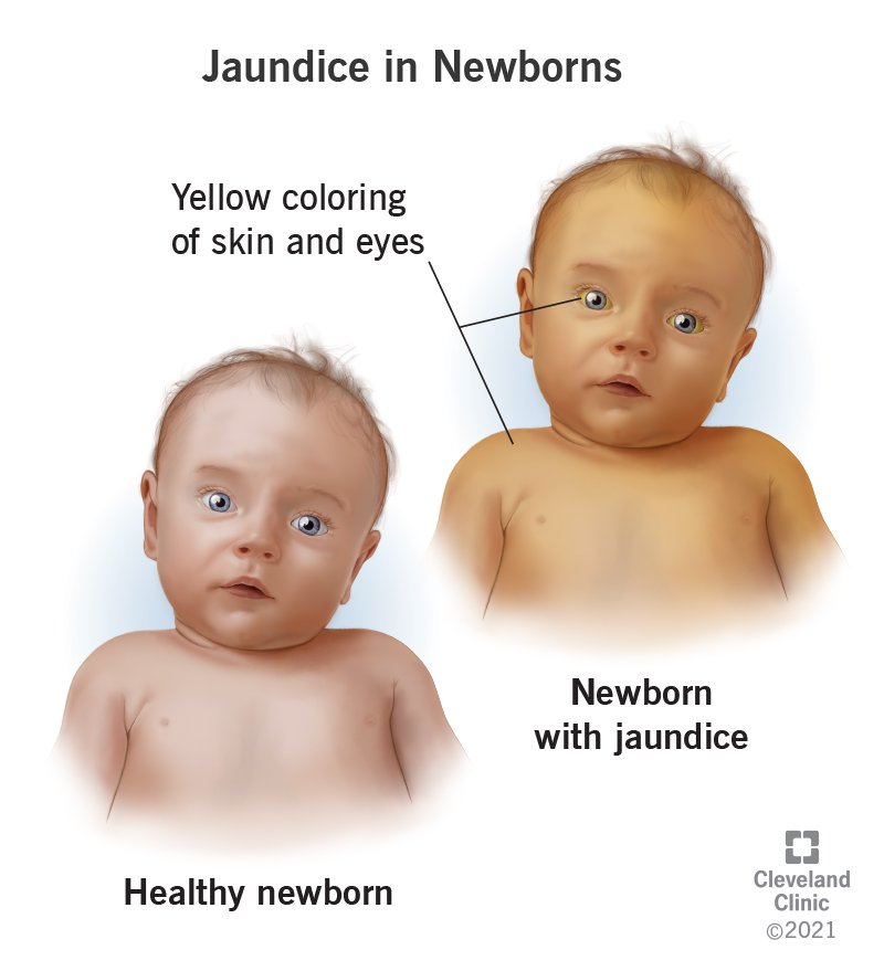 Front Provide an overview of neonatal jaundice