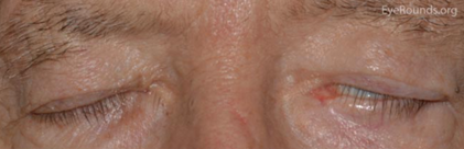 Tags AAO_Ophthalmology::Chapter4::RedEye