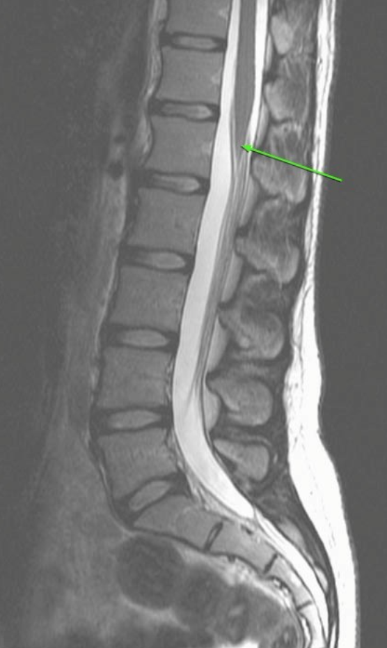 Text {{c1::Conus medullaris::Structure?}}