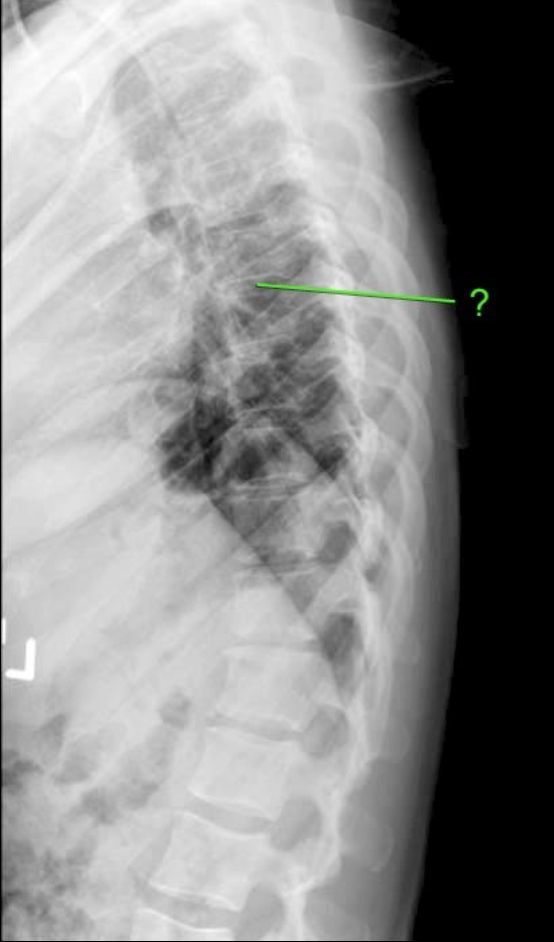 Text {{c1::Intervertebral disk::Name the structure}}