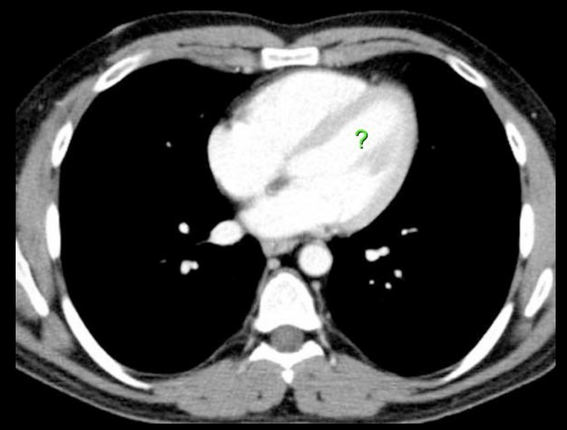 Text {{c1::Left ventricle::Structure?}}