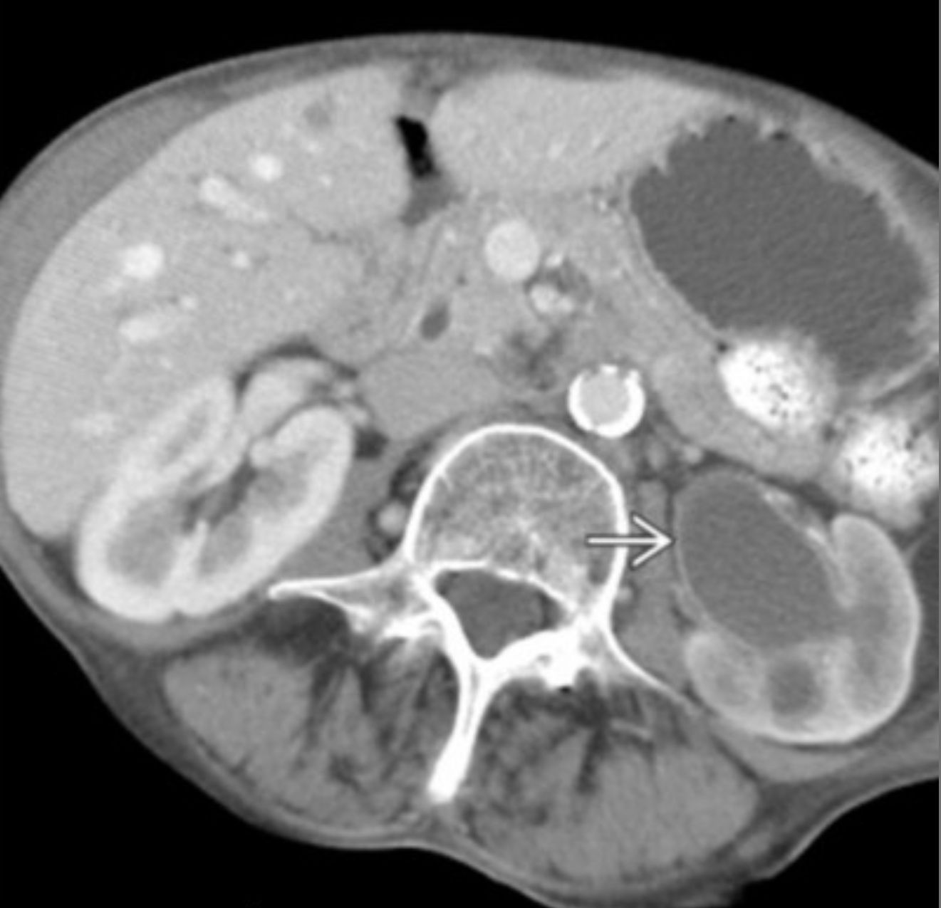 Back Uteritis cystica-typically appearance is smooth small nodular ...
