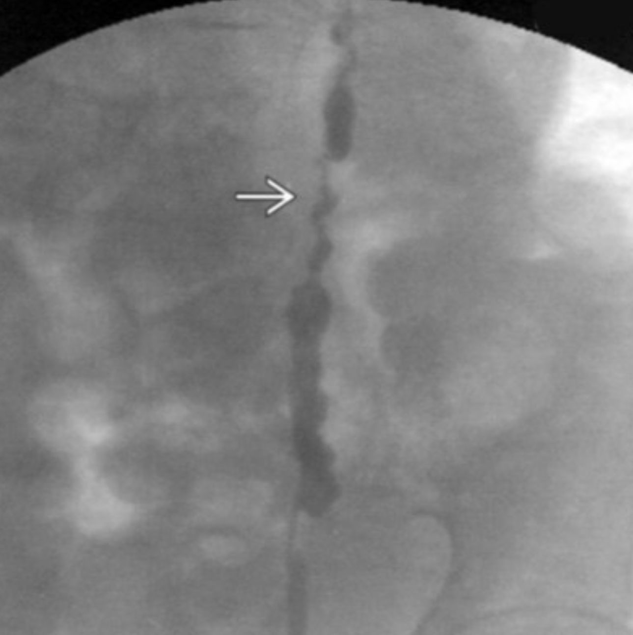 Back Uteritis cystica-typically appearance is smooth small nodular ...