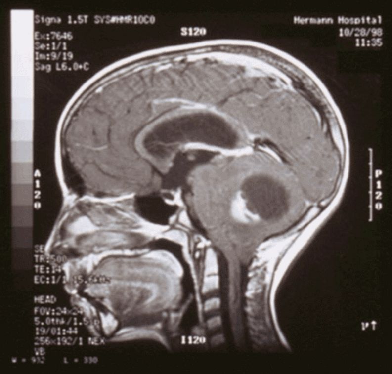 {{c1::Pilocystic astrocytoma}}
