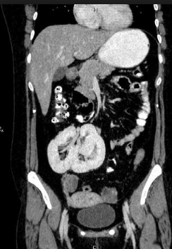 Back -Results from medial renal fusion