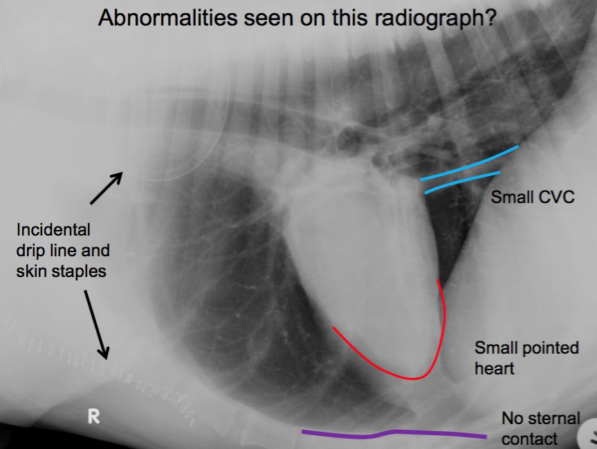 Extra Small heart – microcardia A. Acute myocardial failure B ...