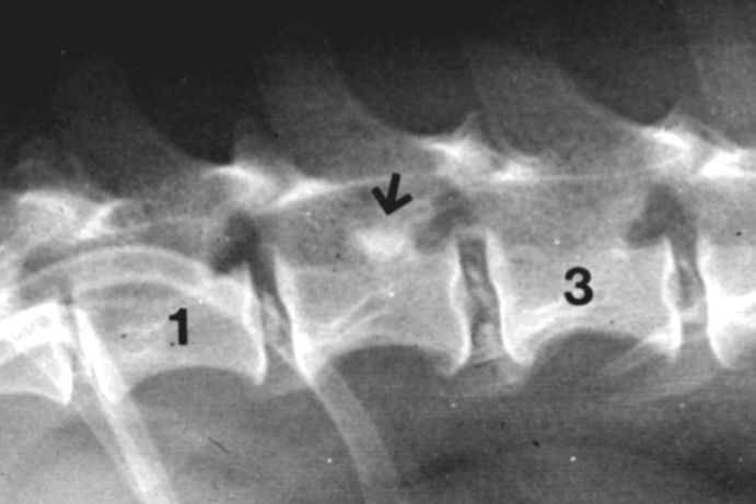 Text Signs of {{c1::Disc Herniation}}