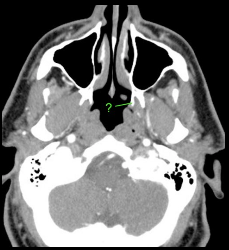 Pterygoid Plate Anatomy Ct
