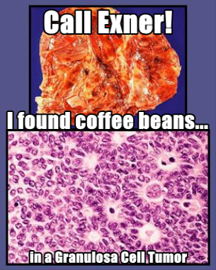 Back CLASSIC LABS/FINDINGSDiagnosis/Disease:"Call-Exner bodies ...