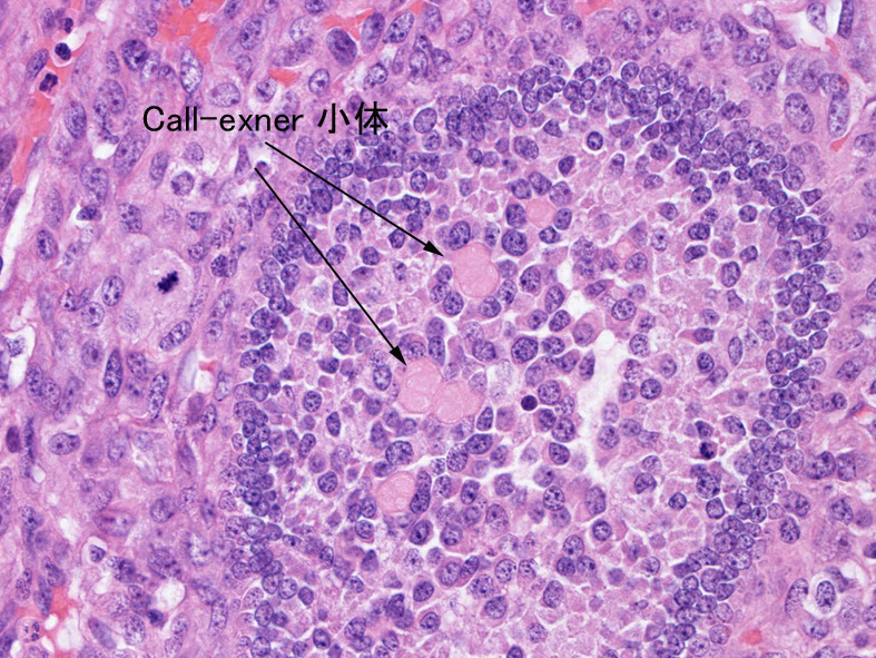 Back CLASSIC LABS/FINDINGSDiagnosis/Disease:"Call-Exner bodies ...