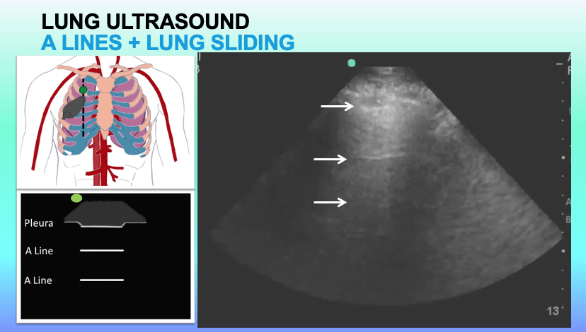 Back A linesArtifact of healthy pleura!