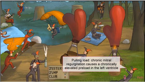 Extra Q11 What can chronic mitral regurgitation progress to?