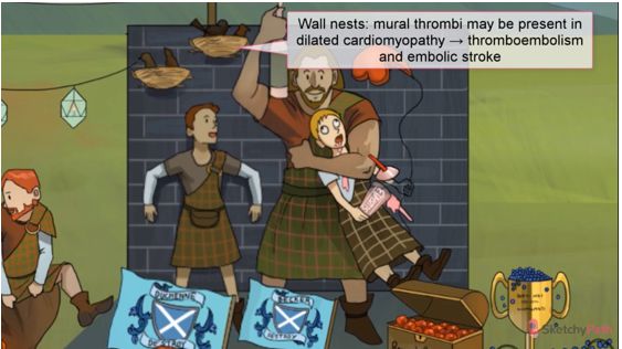 Extra Q13 How can you diagnose dilated cardiomyopathy?