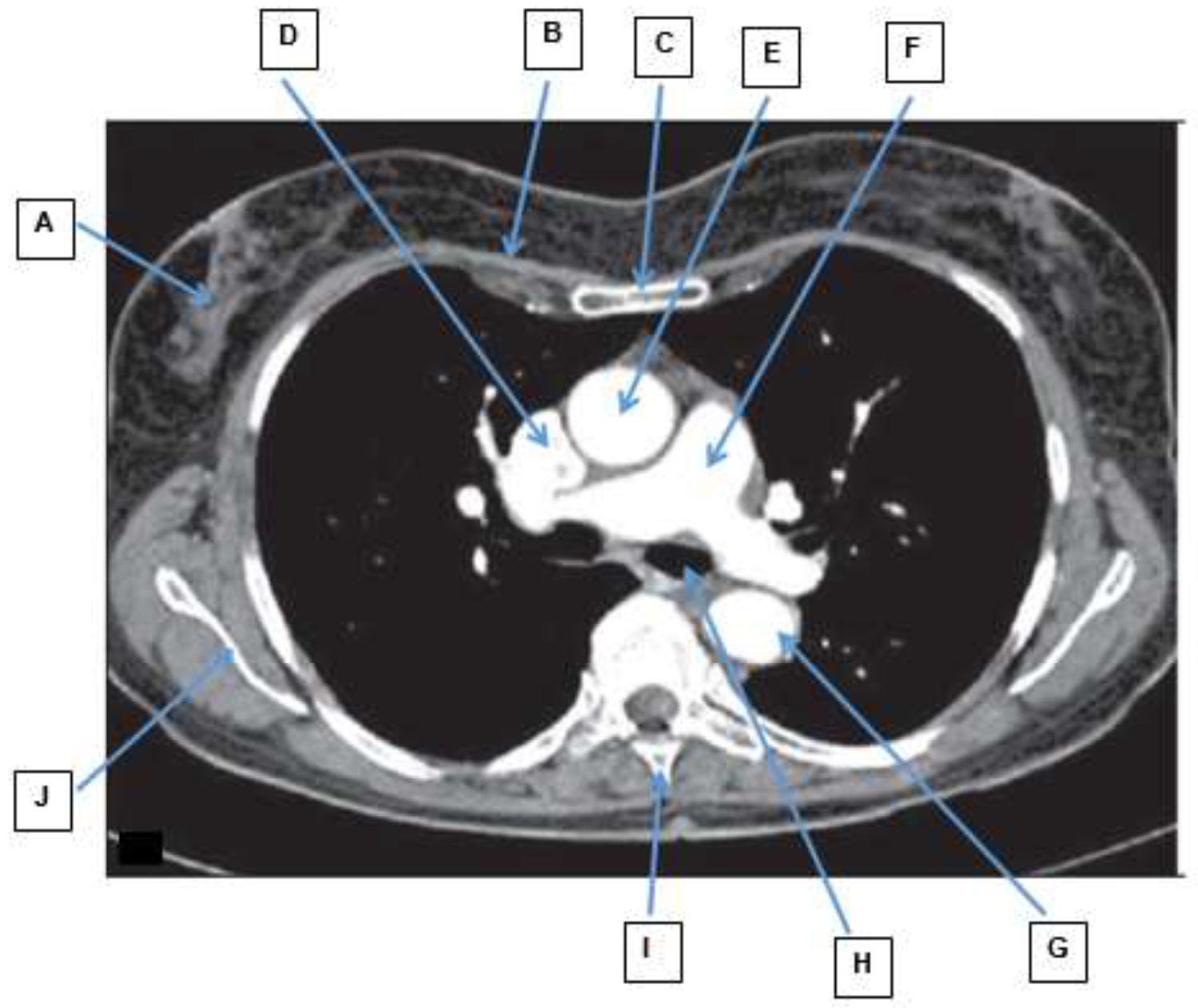 Back A = RIGHT breast glandular tissueB = RIGHT pectoralis majorC ...
