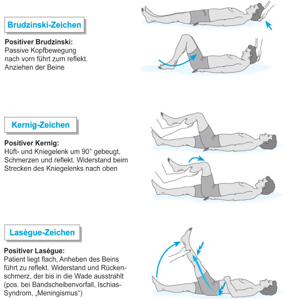 Back positiver Brudzinskipositiver Kernigpositiver Lasegue